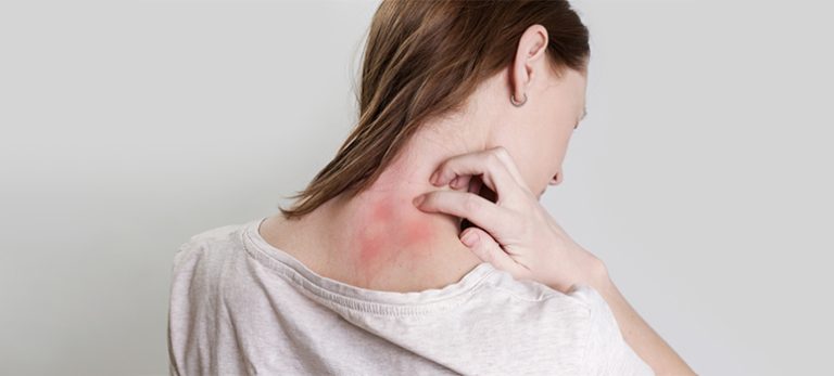 Heat Rash | Skin Rashes Treatment - Skin and Hair Academy