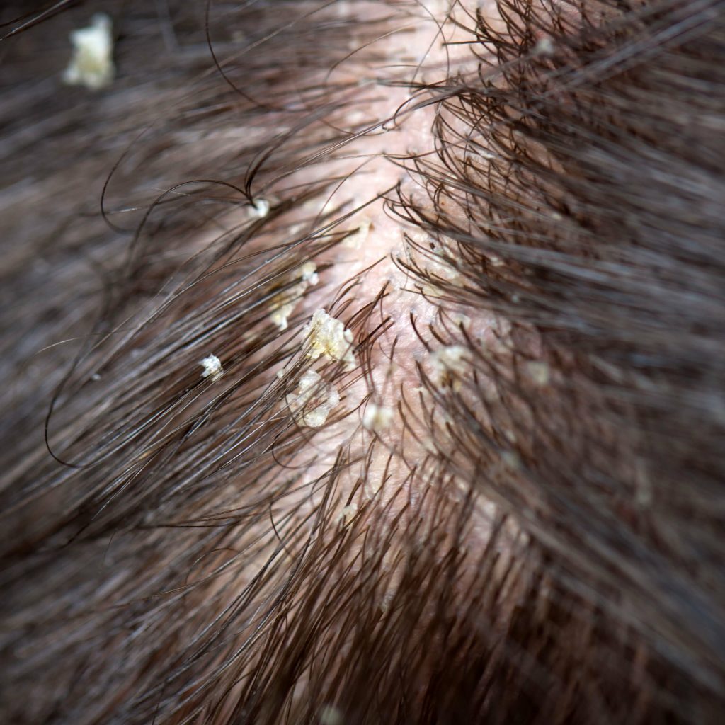 What is Dandruff | Skin And Hair Academy