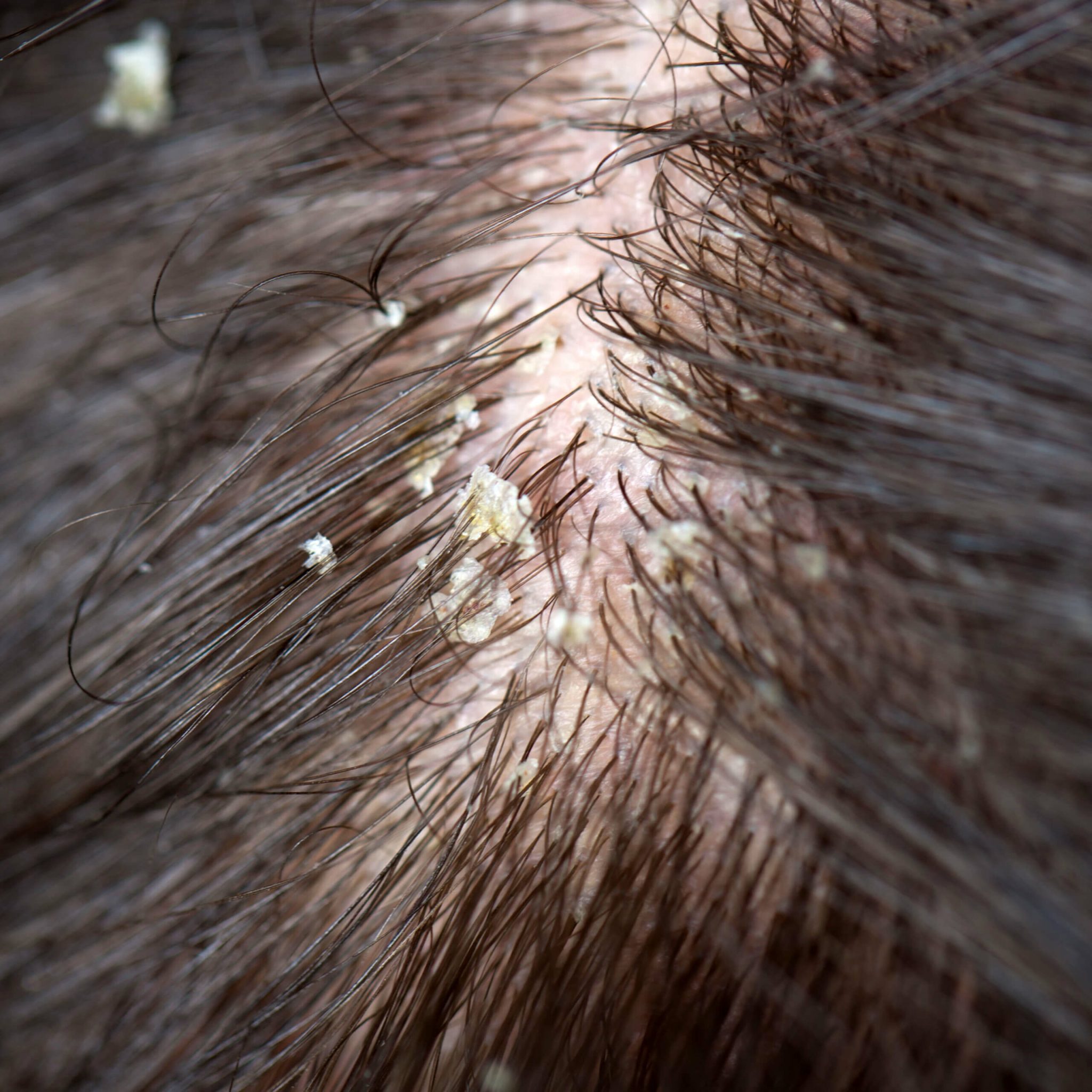 What is Dandruff | Skin And Hair Academy