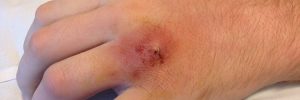 What Is a Staph Infection and How to get rid of it