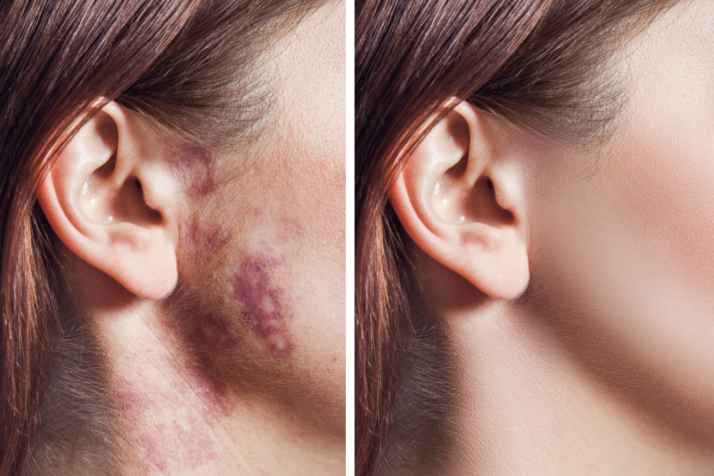 Understanding Birthmarks: Types and Causes