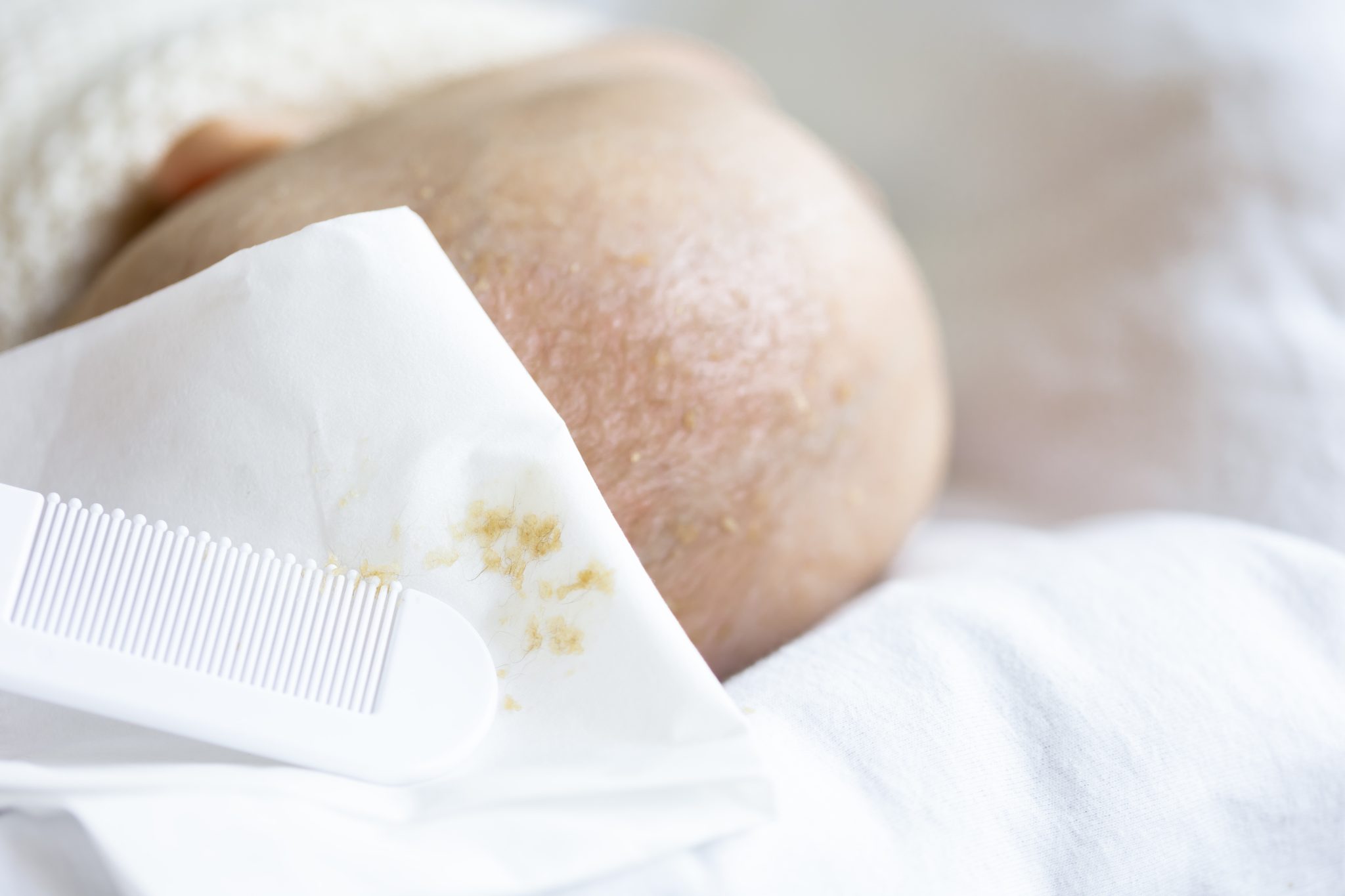 Cradle Cap (Seborrheic Dermatitis): Causes and Treatment
